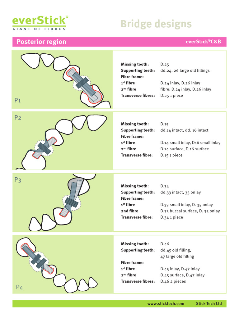 Everstick Posteriorbridgedesign | PDF