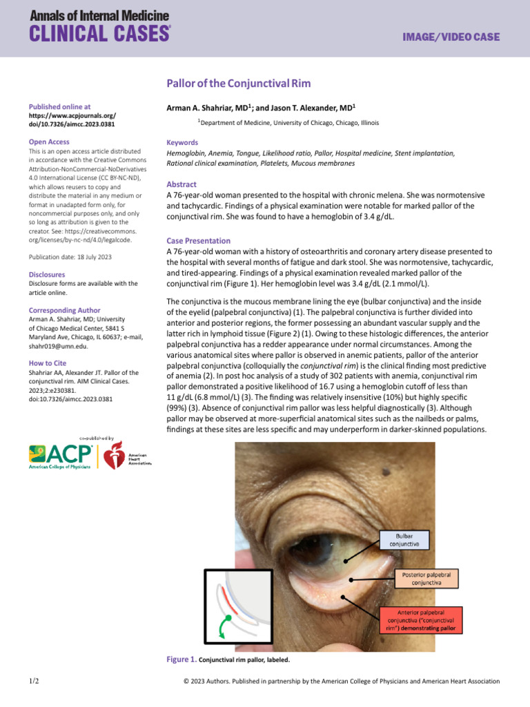 Shahriar Alexander 2023 Pallor of The Conjunctival Rim | PDF | Anemia ...