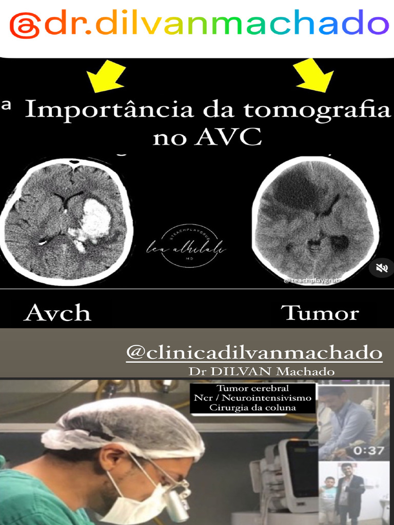 Avc X Tumor | PDF