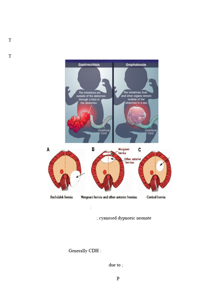 Gastroschisis, Omphalocele, CDH Isense | PDF