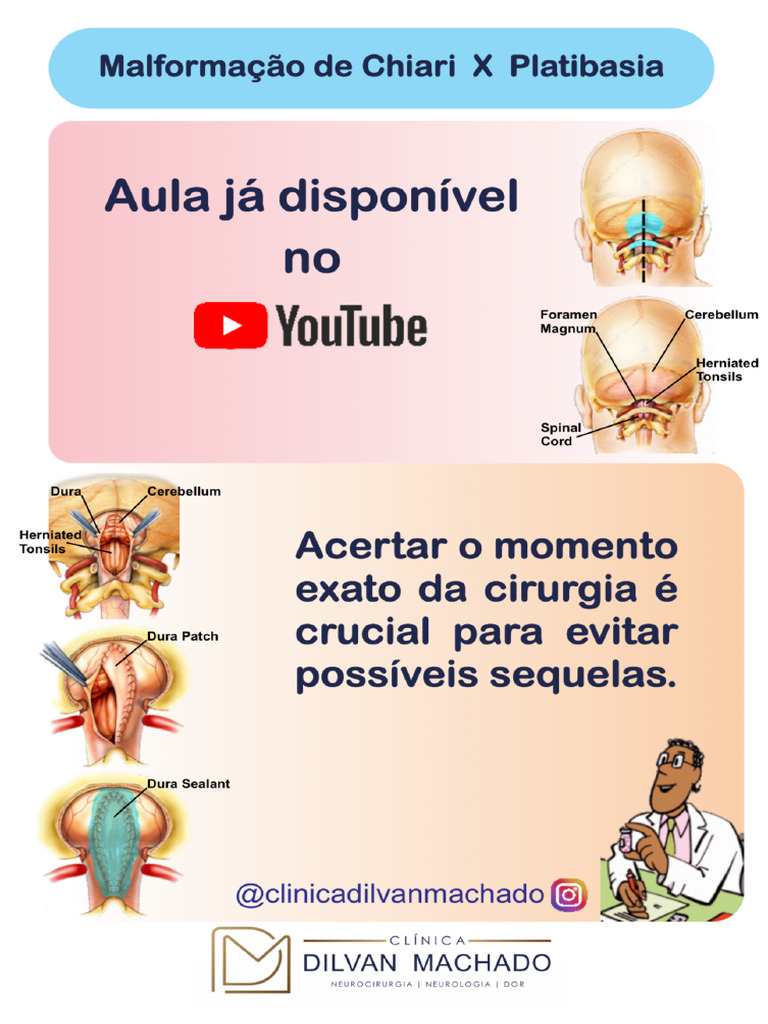 Mal Formação Chiari DR DILVAN | PDF