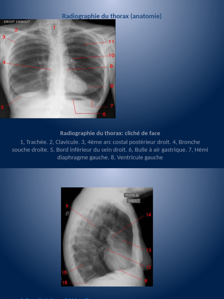 Radiographie Du Thorax (Anatomie) | PDF