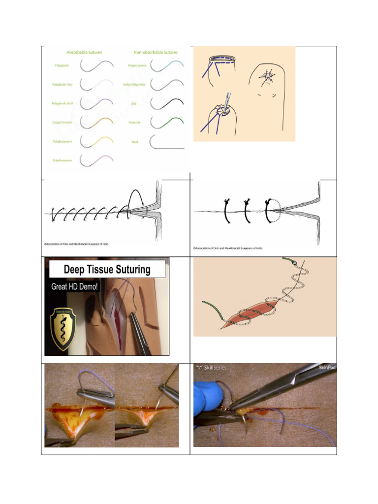 Suturing FFF | PDF