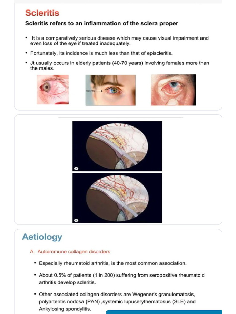 Scleritis | PDF