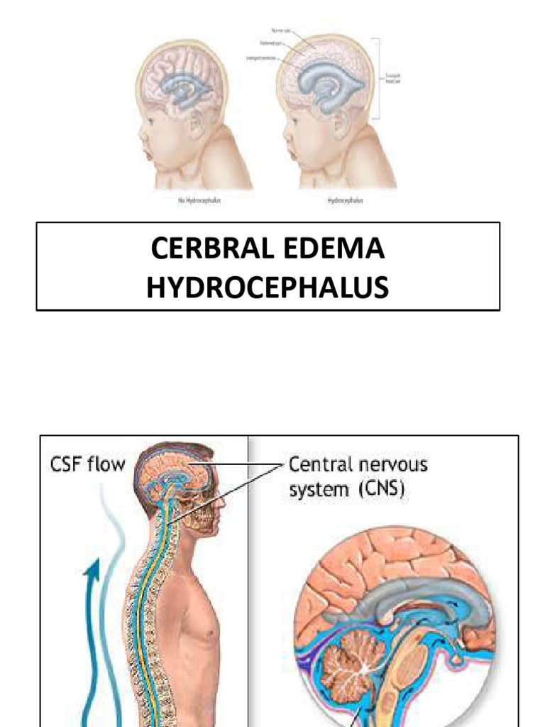 Hydrocephalus | PDF