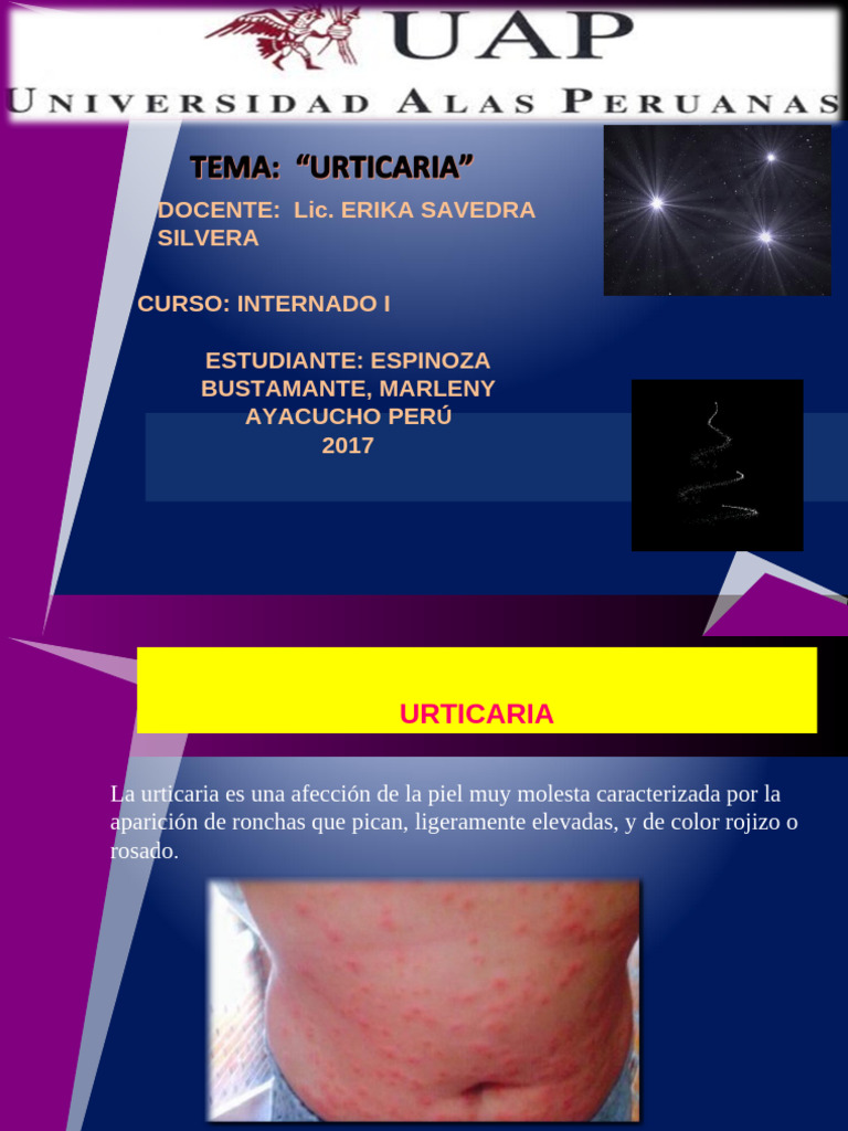 Urticaria | PDF