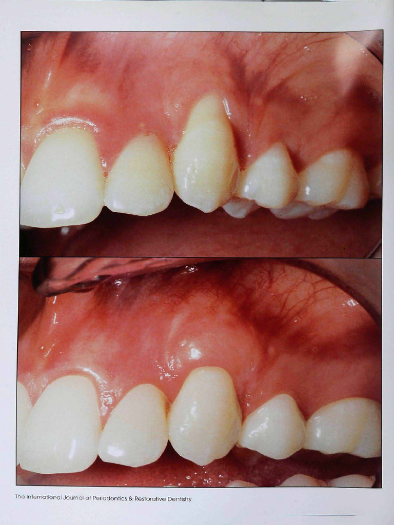 1994 Andrew Allen Uso Del Sobre Supraperióstico en Injertos de Tejido ...