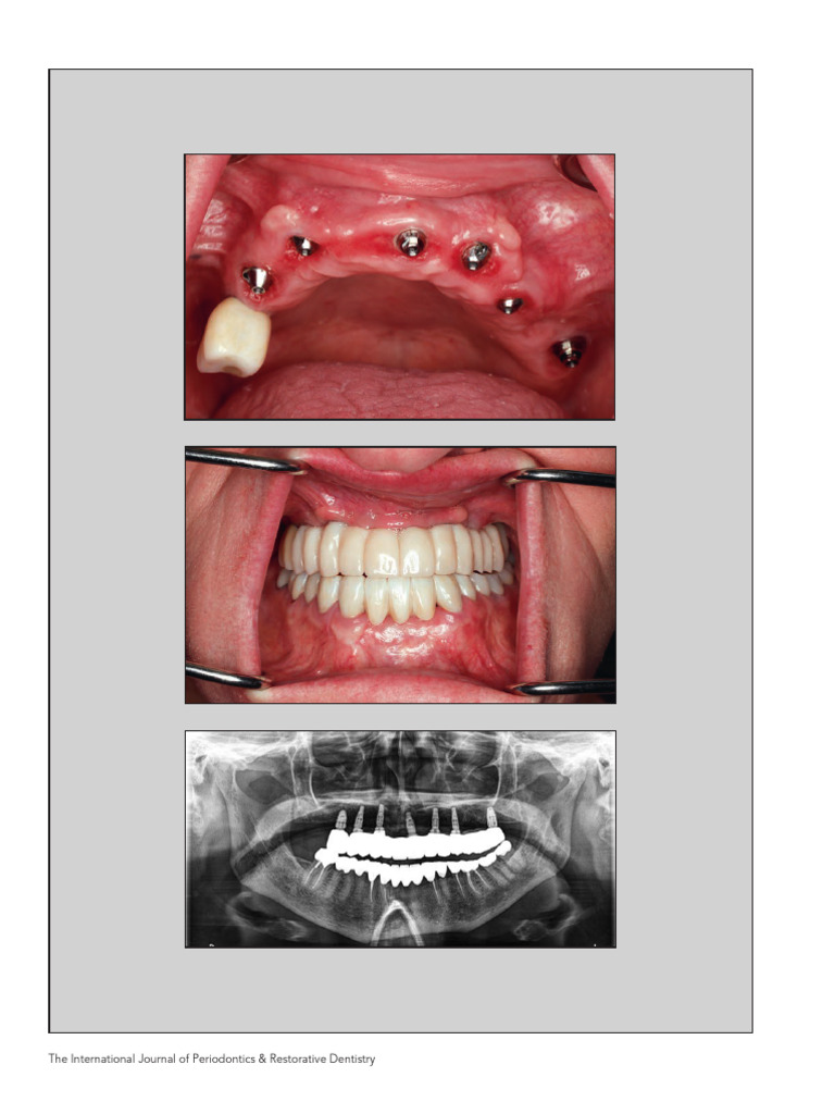 Digital Full-Arch Implant Solutions | PDF | Dental Implant | Dentistry ...