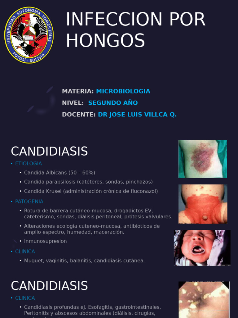 Infeccion Por Hongos | PDF