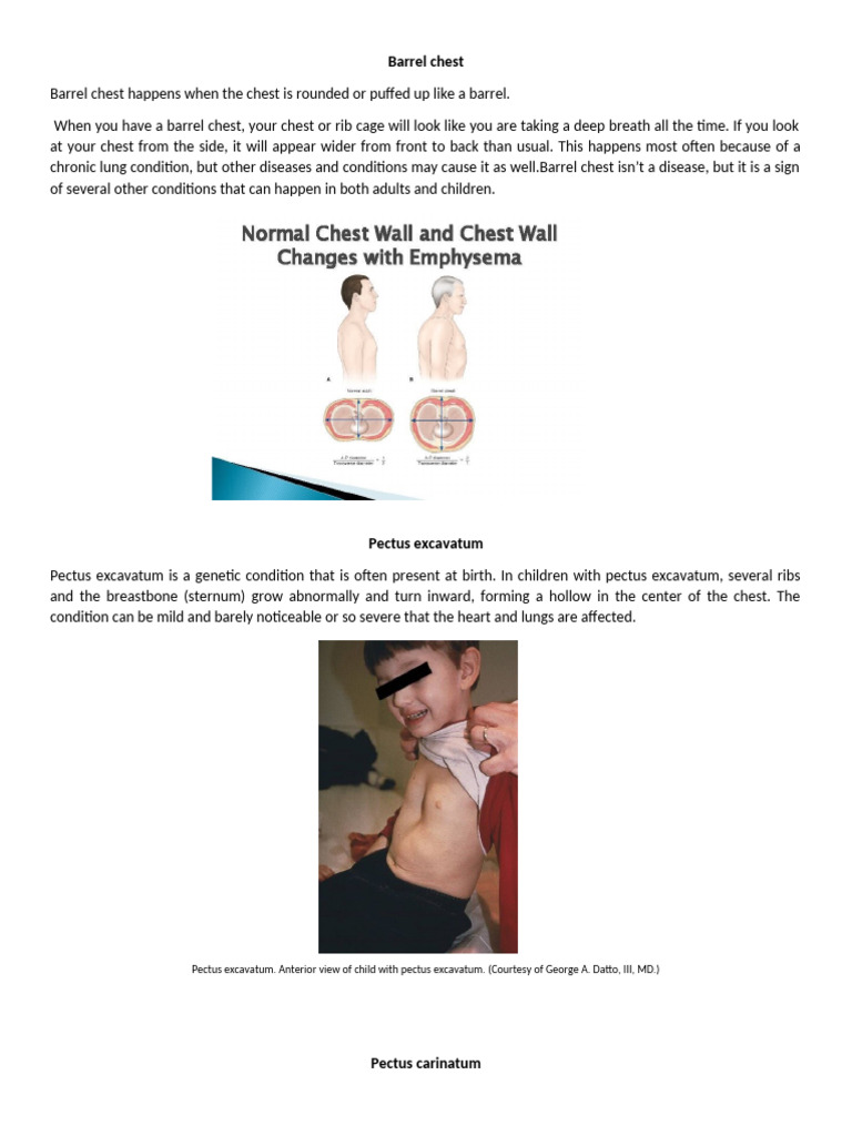 Barrel Chest | PDF