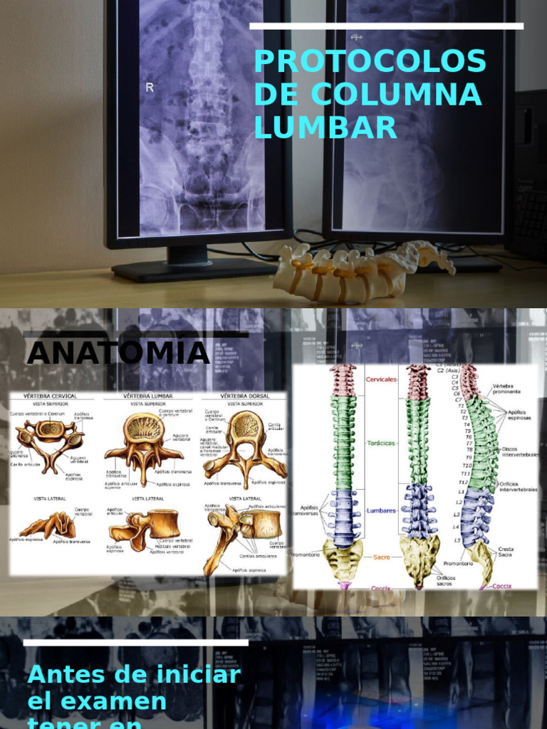 Presentación IRM LUMBAR | PDF