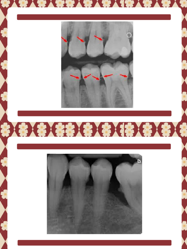 Radiografias Enf Periodontal | PDF