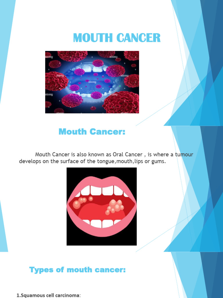Understanding Mouth Cancer: Types, Symptoms, and Treatment | PDF | Self ...
