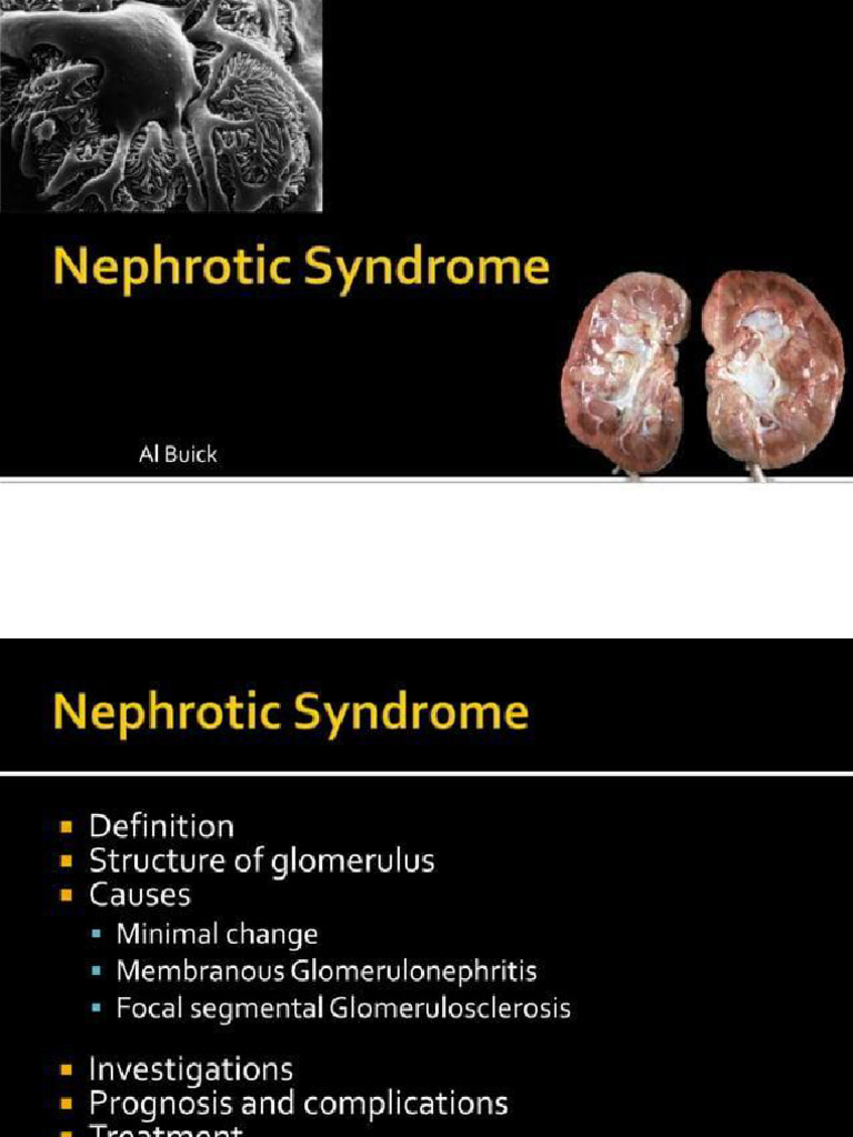 Nephrotic Syndrome | PDF