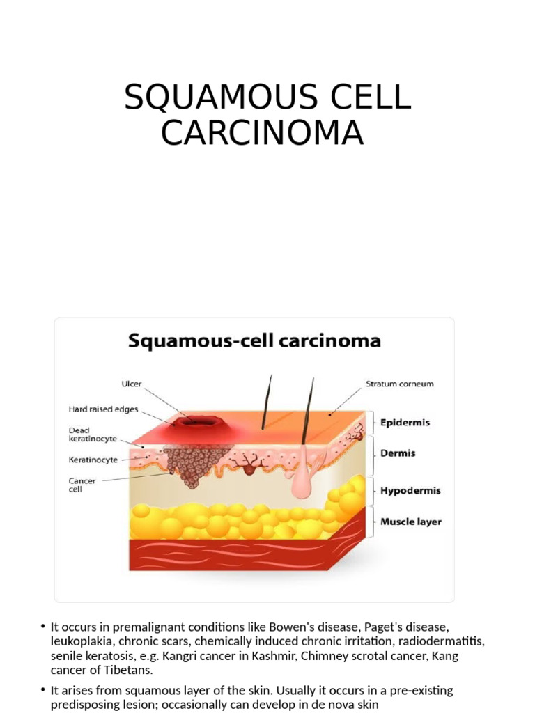 Squamous Cell Carcinoma Overview | PDF | Cancer | Medical Specialties