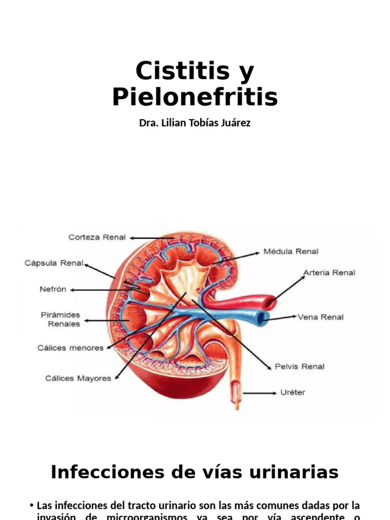 Cistitis y Pielonefritis | PDF | Infección del tracto urinario ...