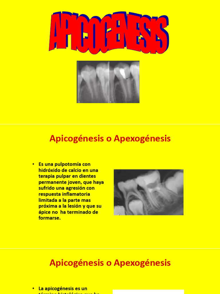Apicogénesis y Apexificación en Odontopediatría | PDF | Calcio ...