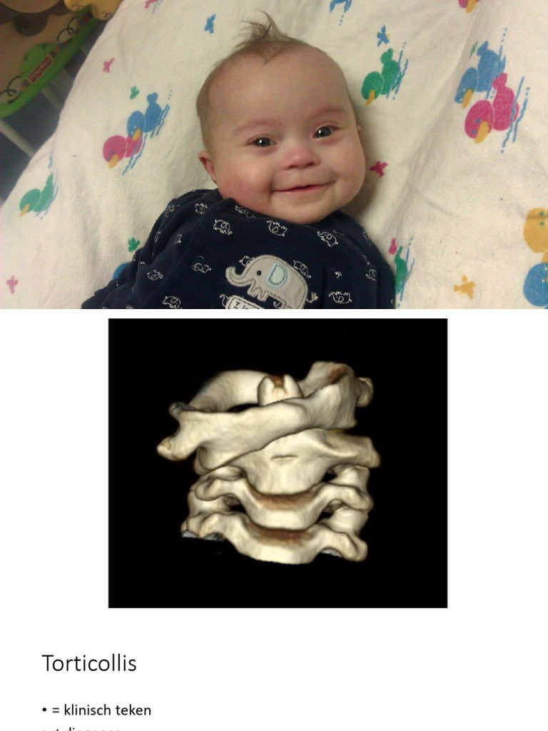 Torticollis | PDF