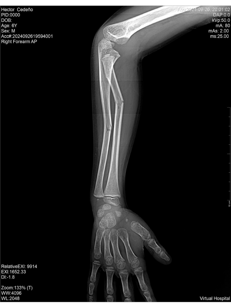 Hector CedeÃ o AP Cubito y Radio | PDF