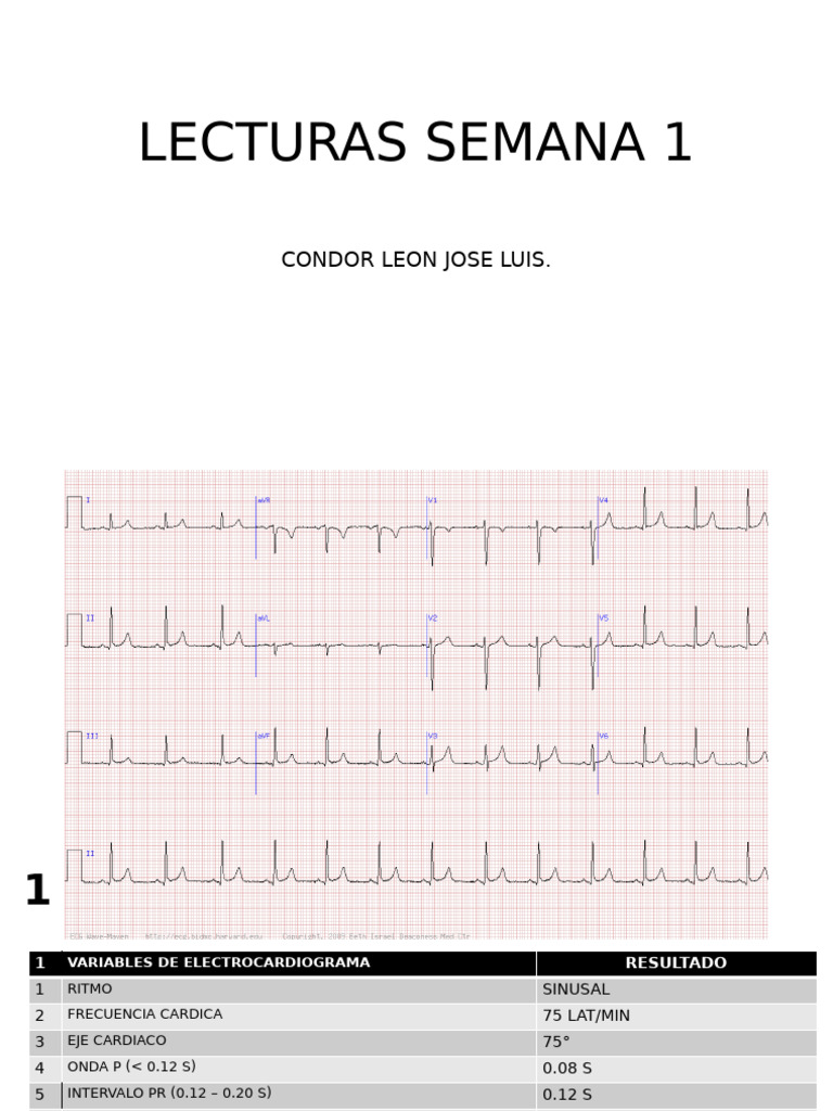 Condor Leon Jose Luis Lectura Ekg | PDF | Electrocardiografia ...