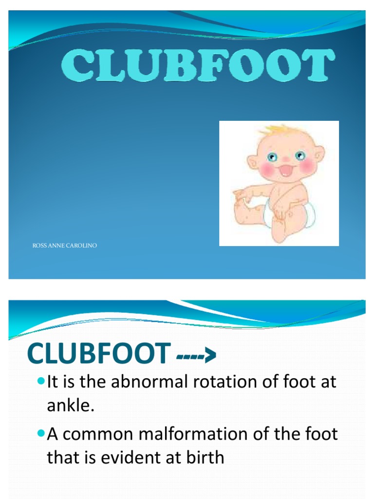 Clubfoot Management and Pathophysiology | PDF