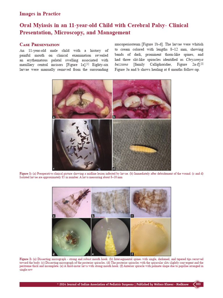 Oral Myiasis in An 11 Year Old Child With Cerebral.24 | PDF | Medical ...