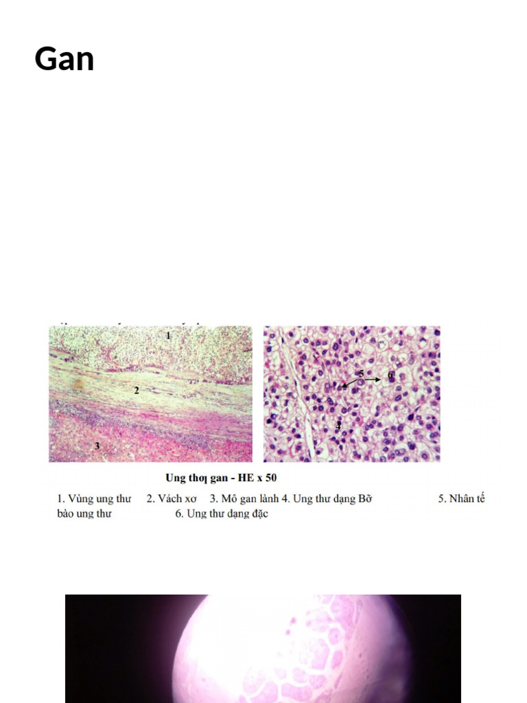 MD Tiêu Hóa GPB | PDF