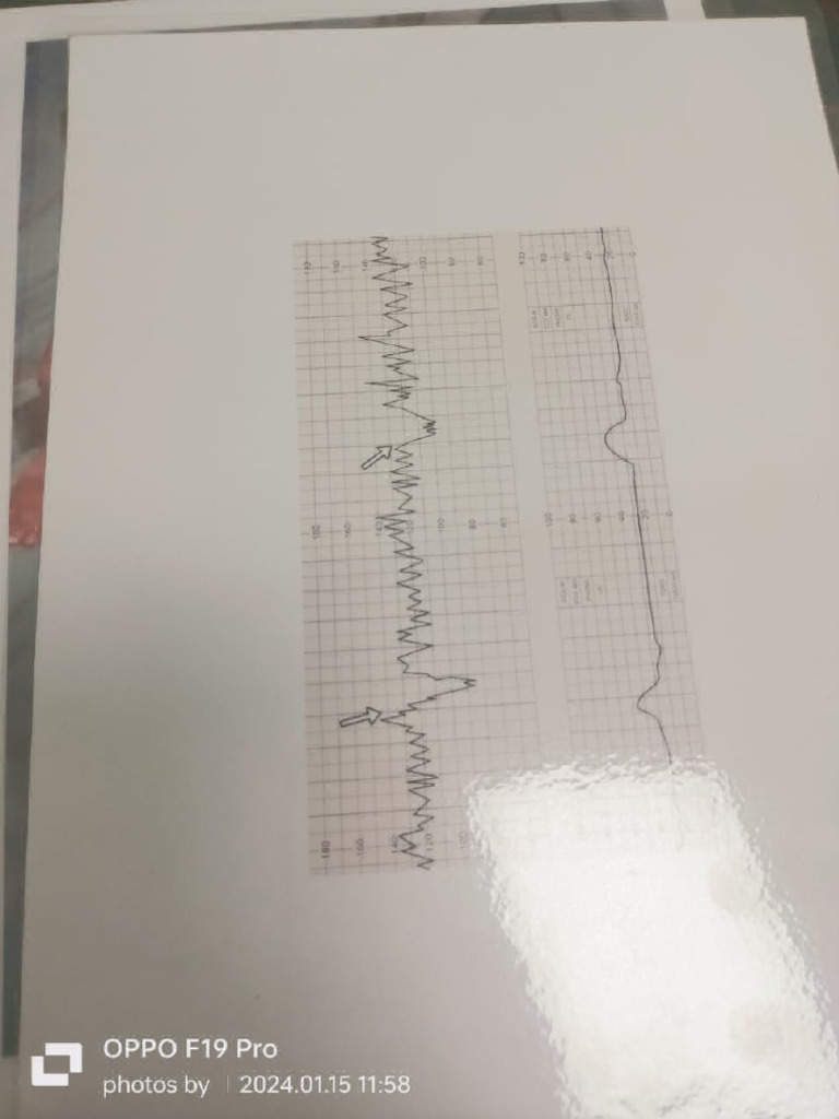 HSG, Partogram CTG | PDF