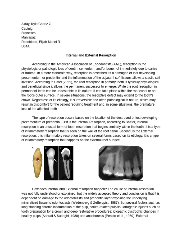 Internal and External Resorption | PDF | Human Tooth | Periodontology
