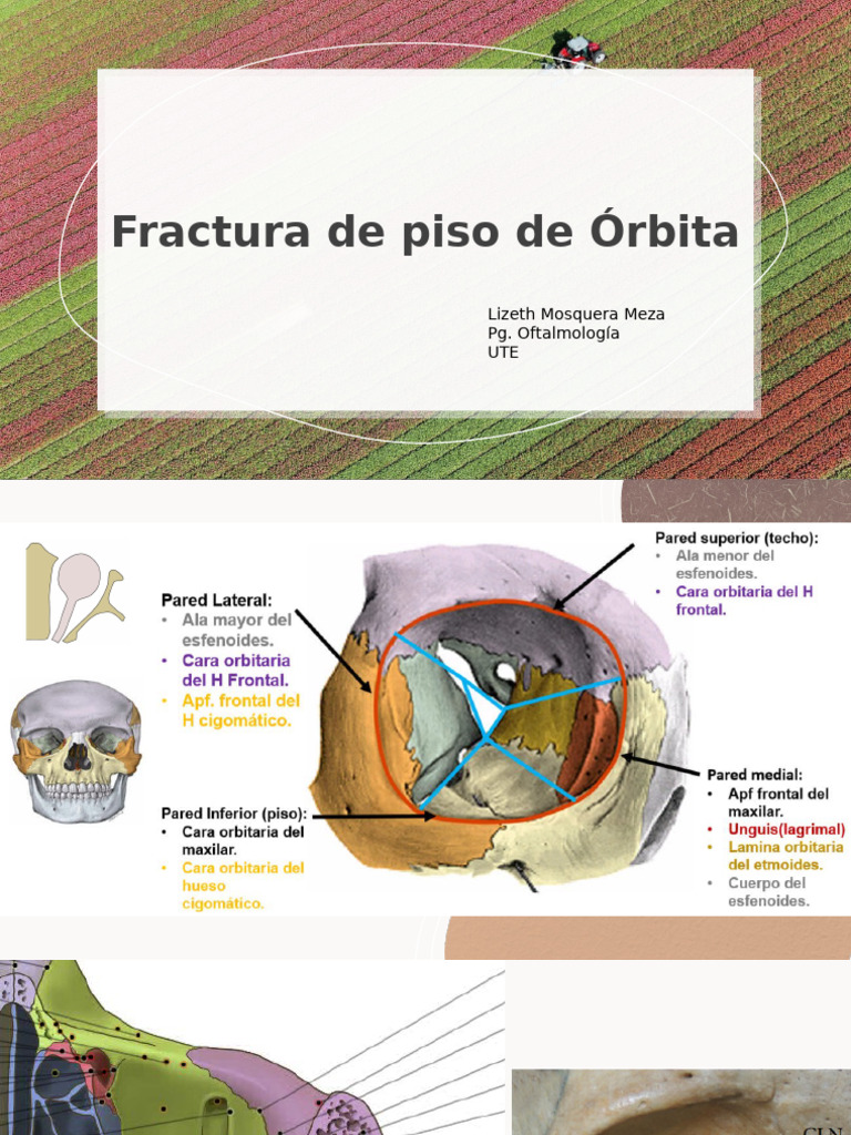 Fractura de Piso de Órbita | PDF