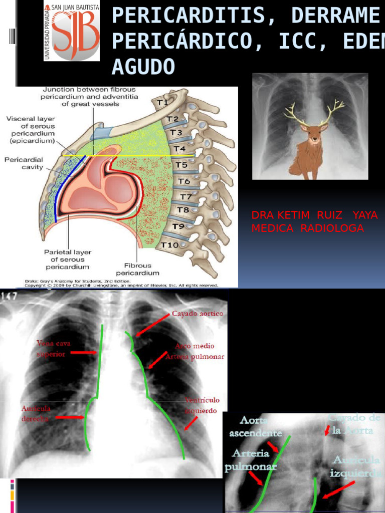 Derrame Pericárdico, Pericarditis, ICC, Edema | PDF | Enfermedades cardiovasculares | Cardiología