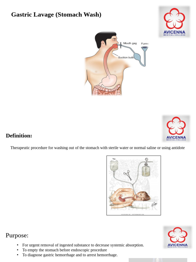 Gastric Lavage | PDF | Stomach | Medical Specialties