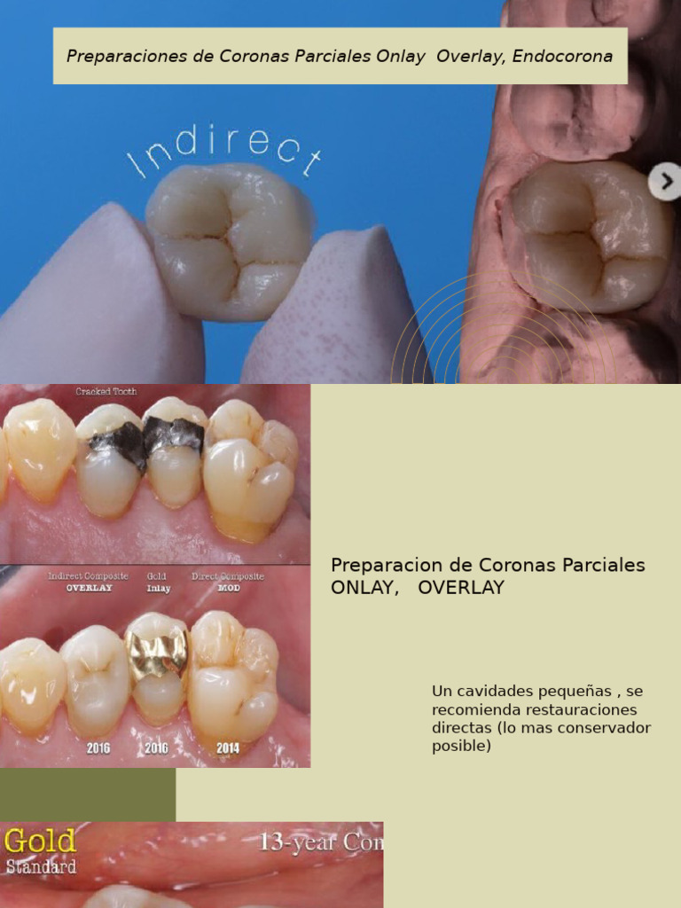 Onlay y Overlay | PDF | Compuesto Dental | Diente