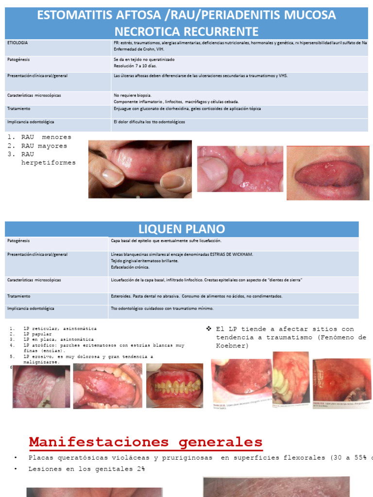 Estomatitis Aftosa /Rau/Periadenitis Mucosa Necrotica Recurrente | PDF ...