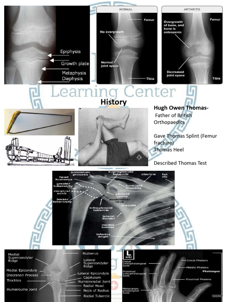 Overview of Orthopedic Fractures and Treatments | PDF | Hip ...