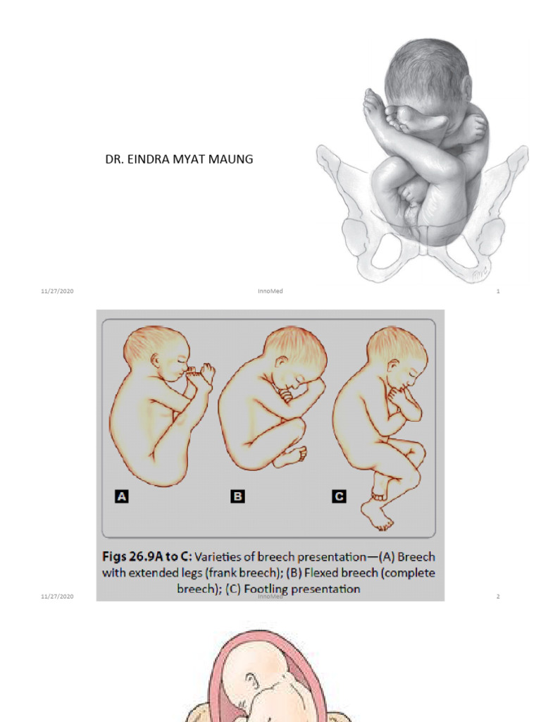 Breech Presentation | PDF