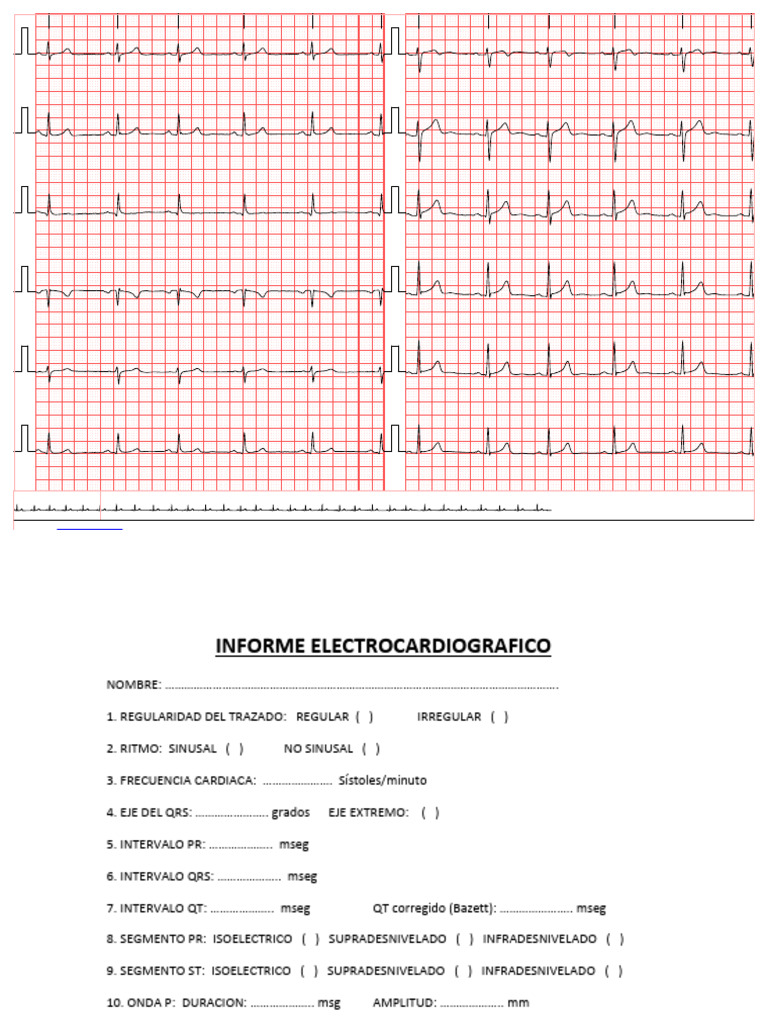Informe Electrocardiografico | PDF