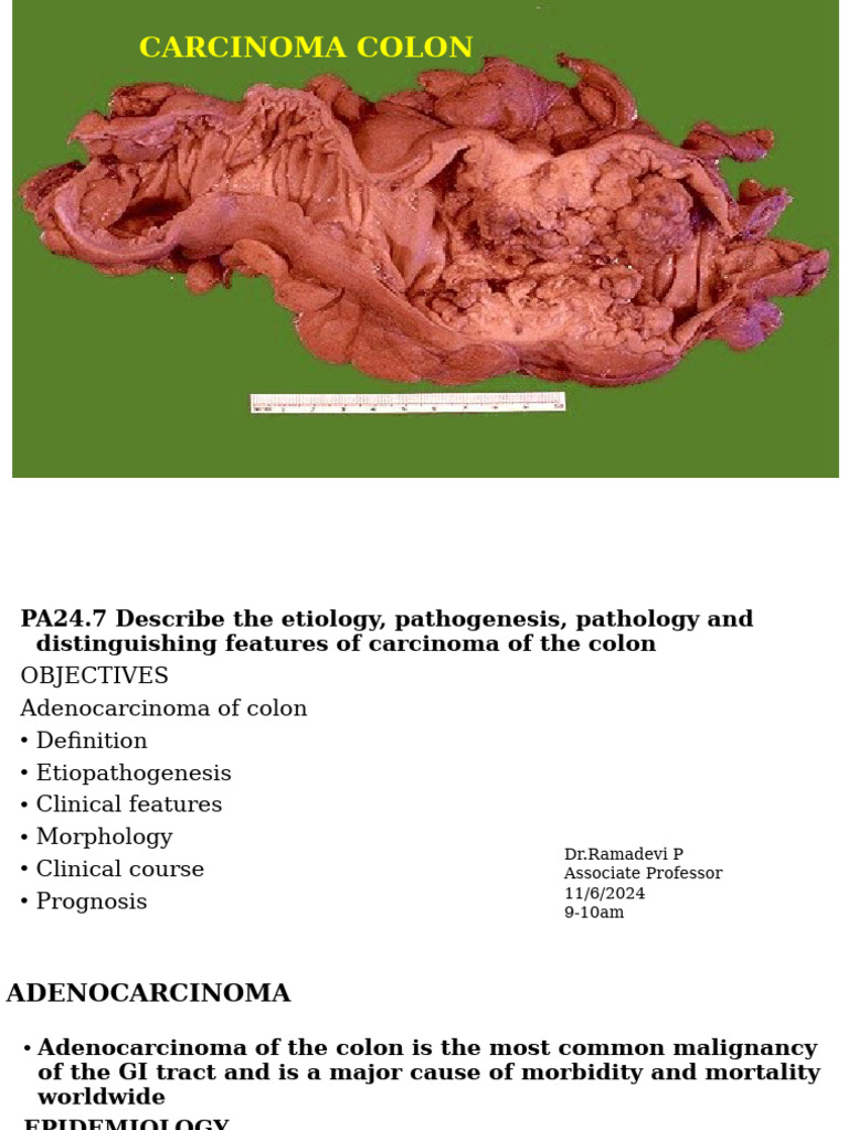 Carcinoma Colon | PDF | Colorectal Cancer | Neoplasms