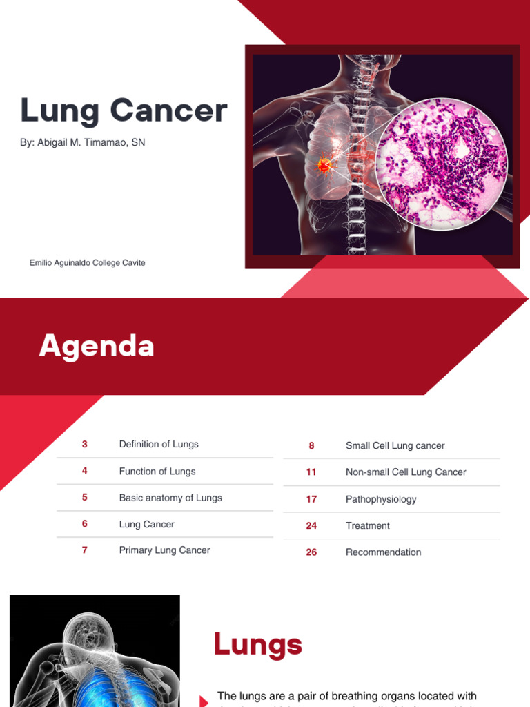 LUNG CANCER | PDF | Lung Cancer | Lung