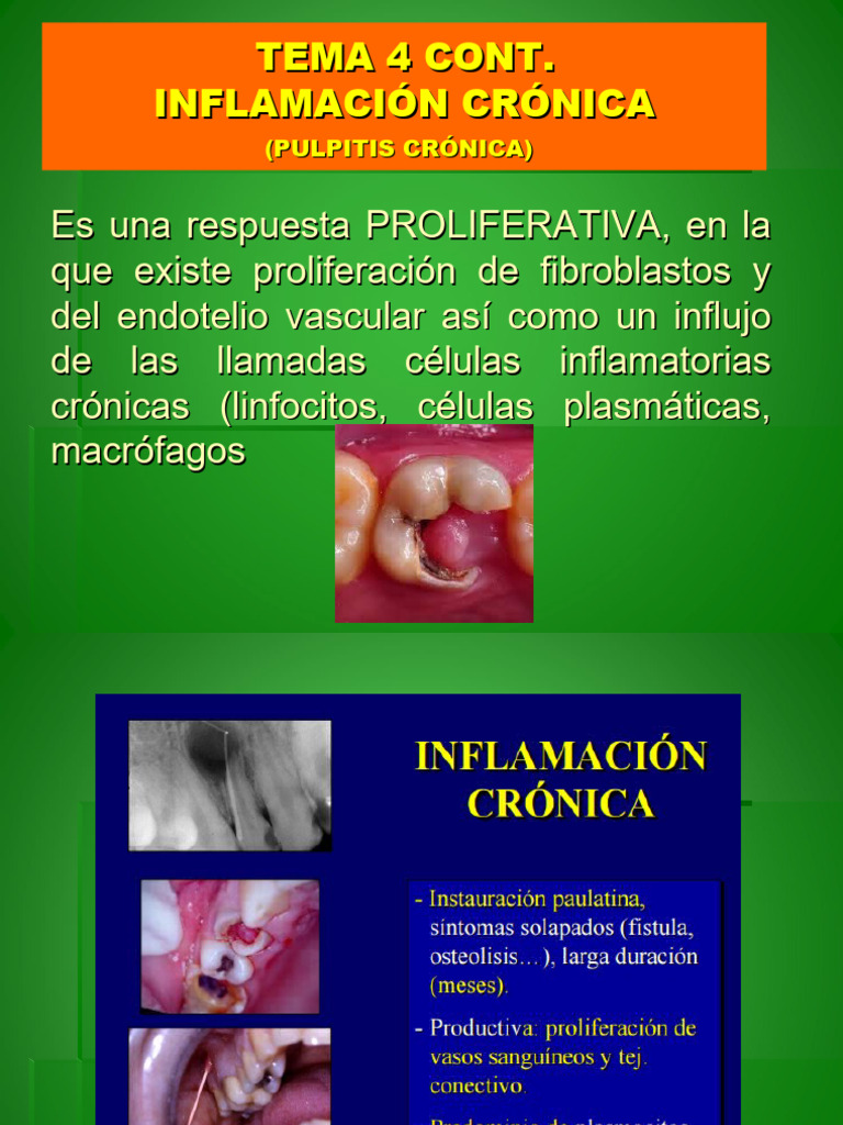 Tema 4 Cont. Pulpitis Cronica | PDF | Inflamación | Macrófago
