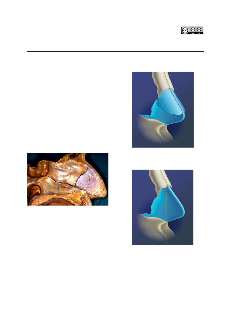 Septoplasty in Rhinoplasty Surgery | PDF | Human Nose | Human Head And Neck