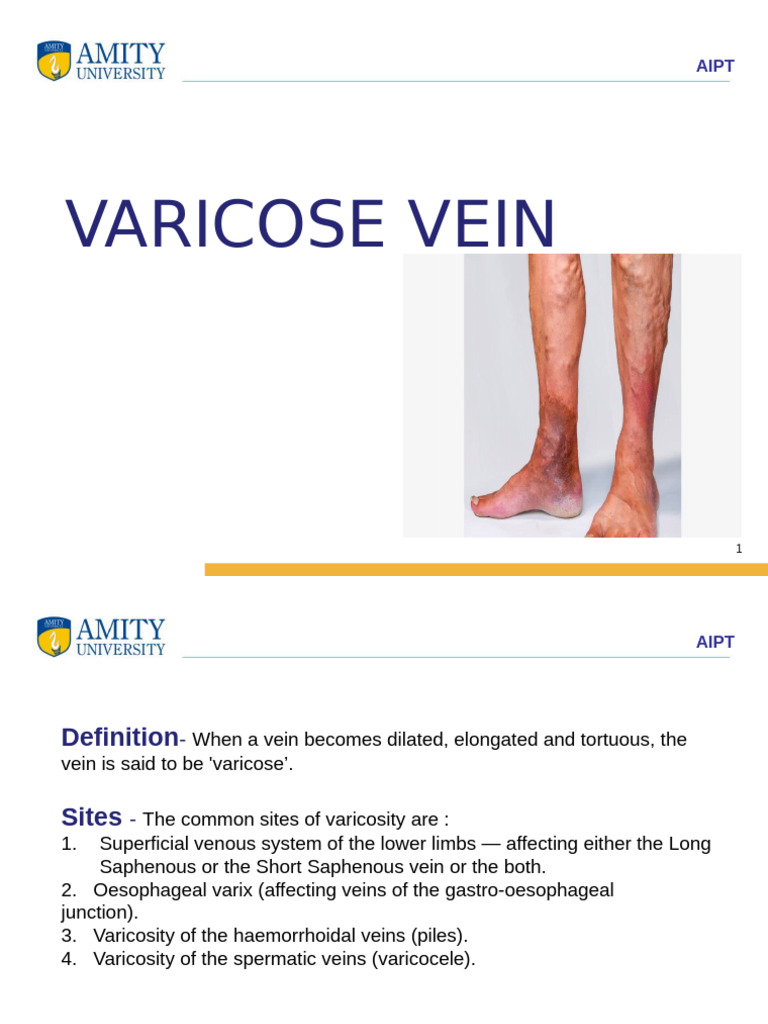 VARICOSE VEIN | PDF | Vein | Varicose Veins