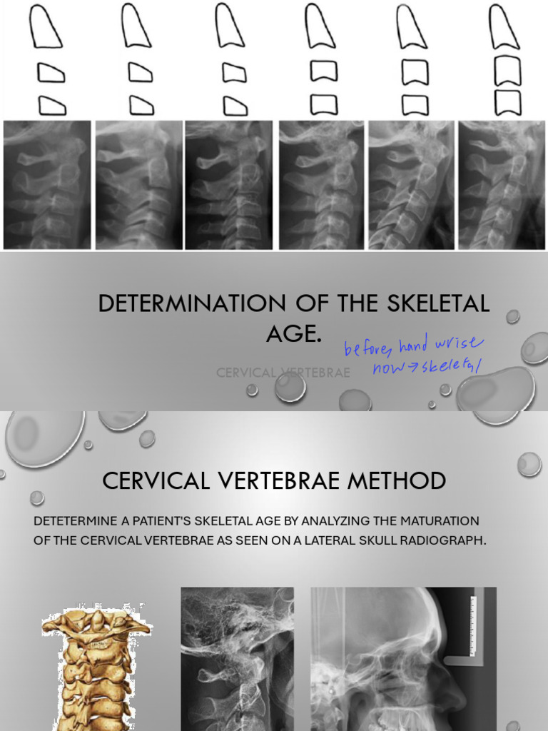 Cervical Vertebrae. Skeletal age determination | PDF | Vertebra | Human ...
