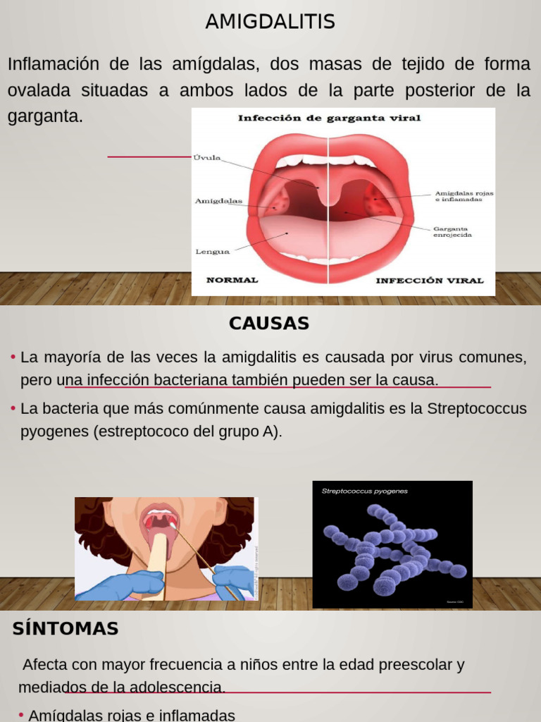 Amigdalitis | PDF | Inmunología | Especialidades Medicas