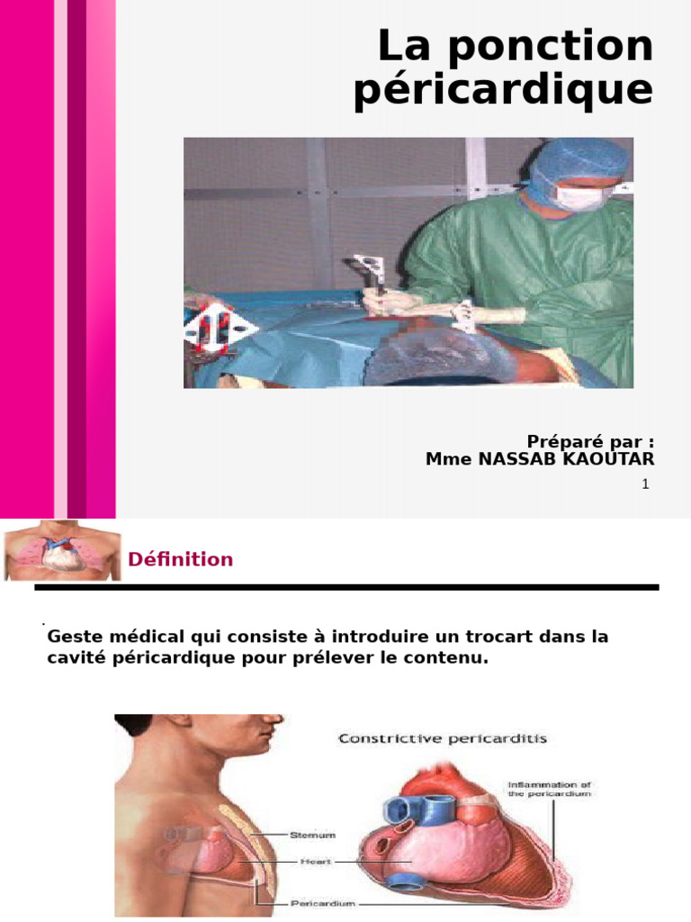 Ponction péricardique : technique et risques | PDF | Hémostasie ...