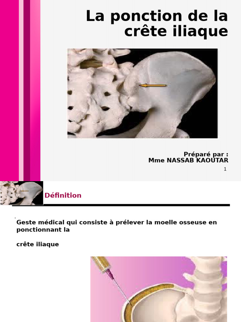 Ponction Crête Iliaque : Guide Complet | PDF | Biopsie | Maladies et ...
