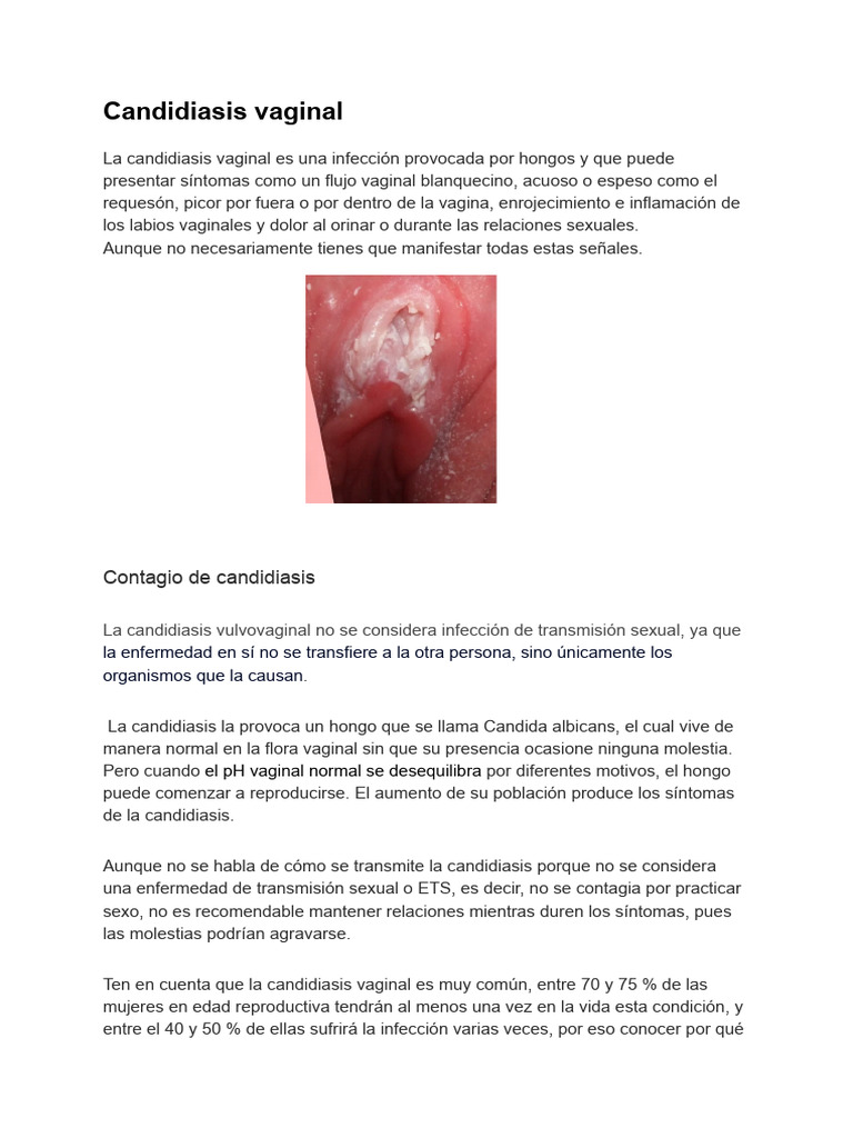 Candidiasis vaginal: síntomas y tratamiento | PDF | Candidiasis ...