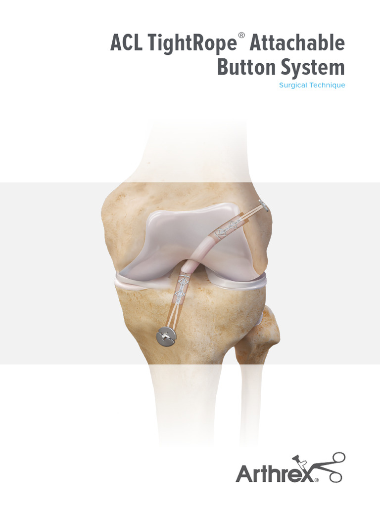 Acl Tightrope Attachable Button System | PDF | Musculoskeletal System ...