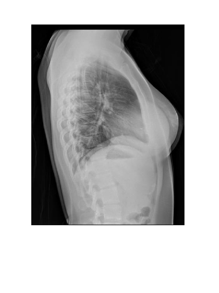 RX Lateral Torax | PDF