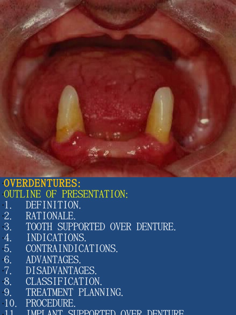 Tooth Supported Overdentures Overview | PDF | Dentures | Dental Implant